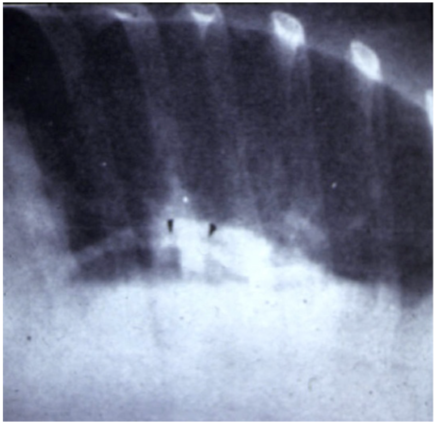 Carbon Dioxide Digital Subtraction Angiography CO2 DSA VDM carbon-dioxide-digital-subtraction-angiography-co2-dsa-vdm